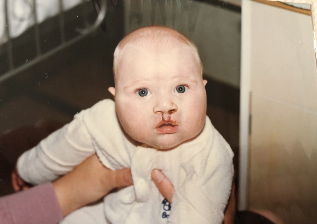 Cleft Lip & Palate Association