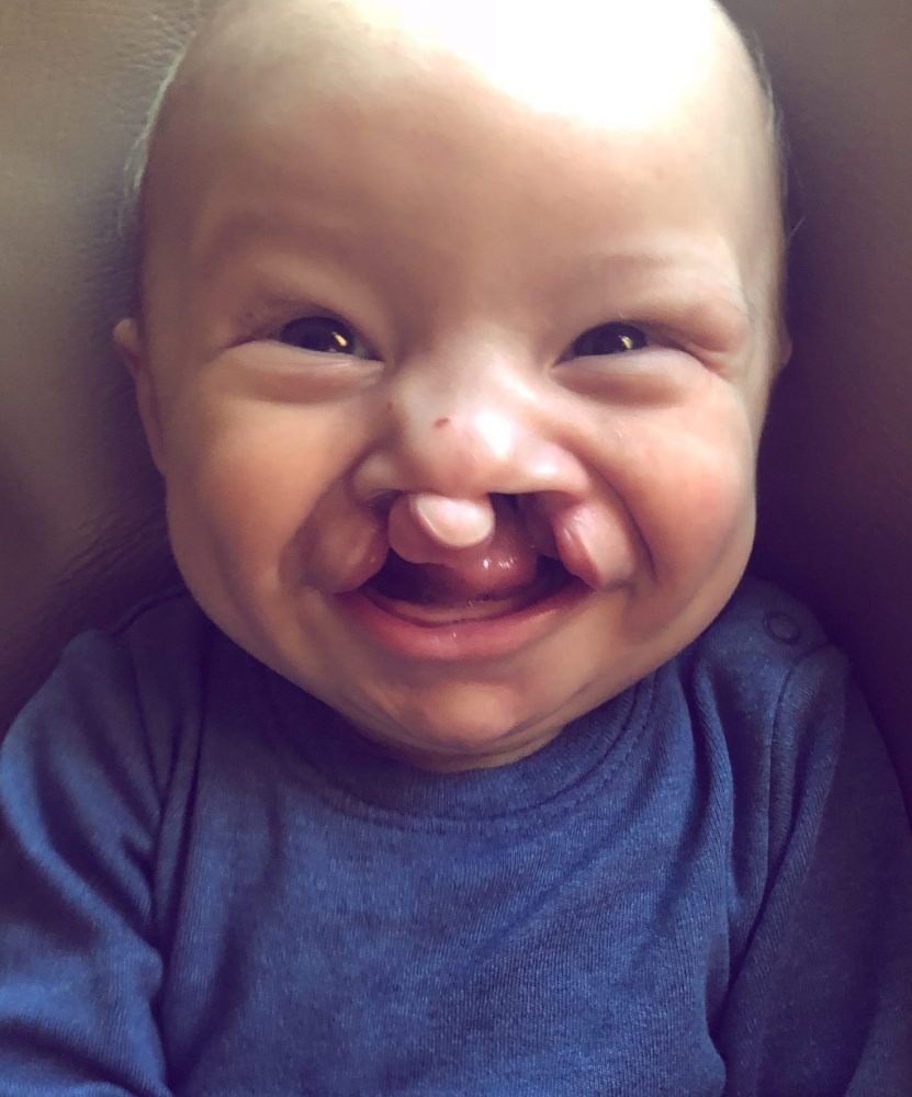How Do Babies Get Cleft Lips And Palates | Lipstutorial.org How Do Babies Get Cleft Lips And Palates | Lipstutorial.org